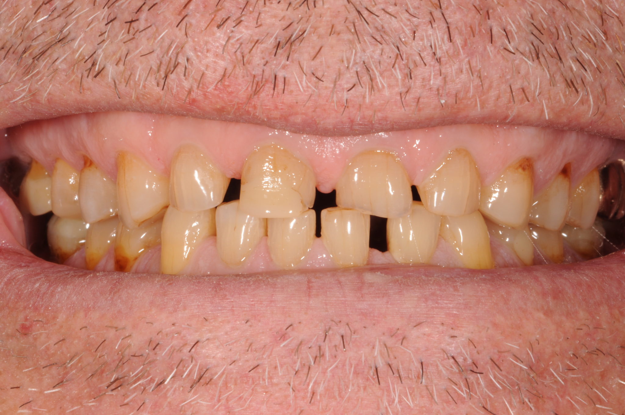 Le bruxisme, ce mal méconnu qui vous lime les dents